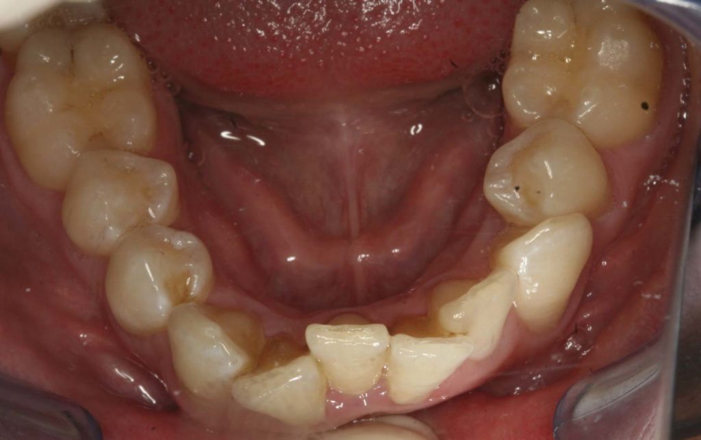 Conservative mini smile makeovers – Enlighten Smiles Blog