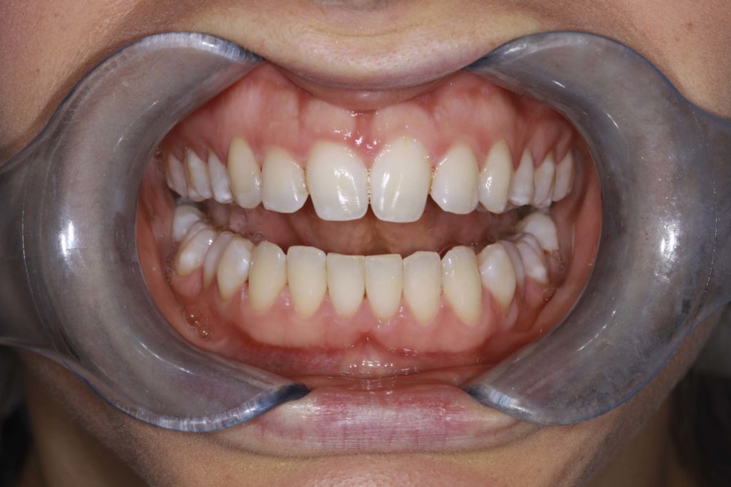 Your guide to teeth whitening – Enlighten Smiles Blog