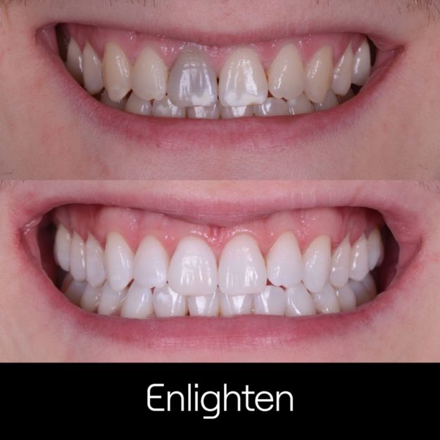 All you need to know about the Enlighten system – Enlighten Smiles Blog
