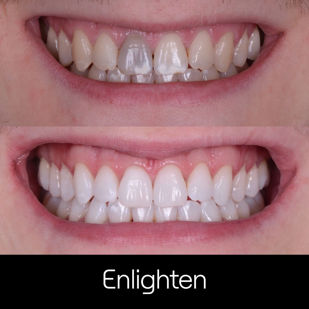 All you need to know about the Enlighten system – Enlighten Smiles Blog