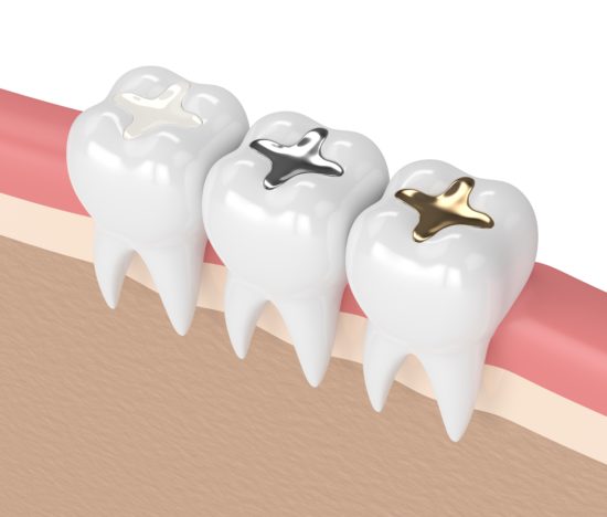 How do fillings work? – Enlighten Smiles Blog How do fillings work? – Enlighten Smiles Blog