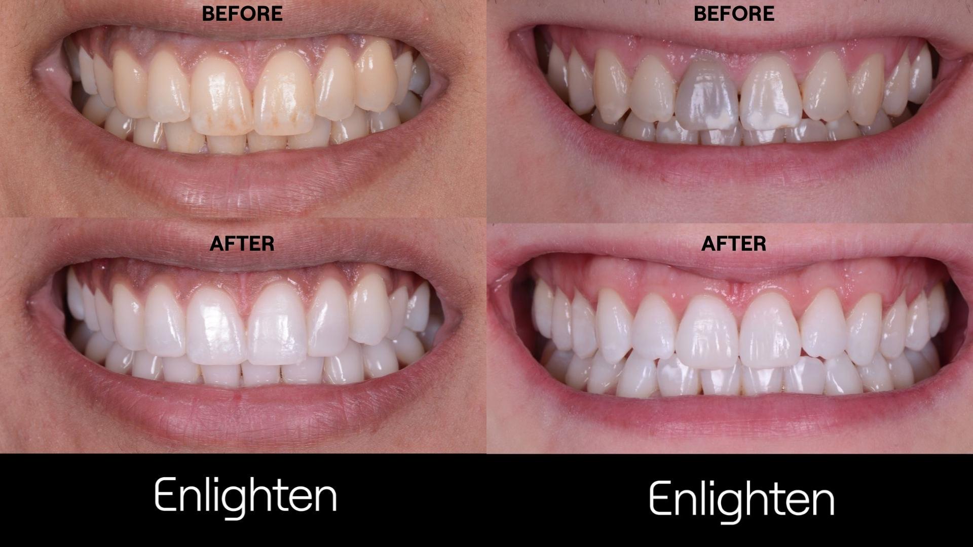 All you need to know about Enlighten Smiles (part 2) – Enlighten Smiles ...