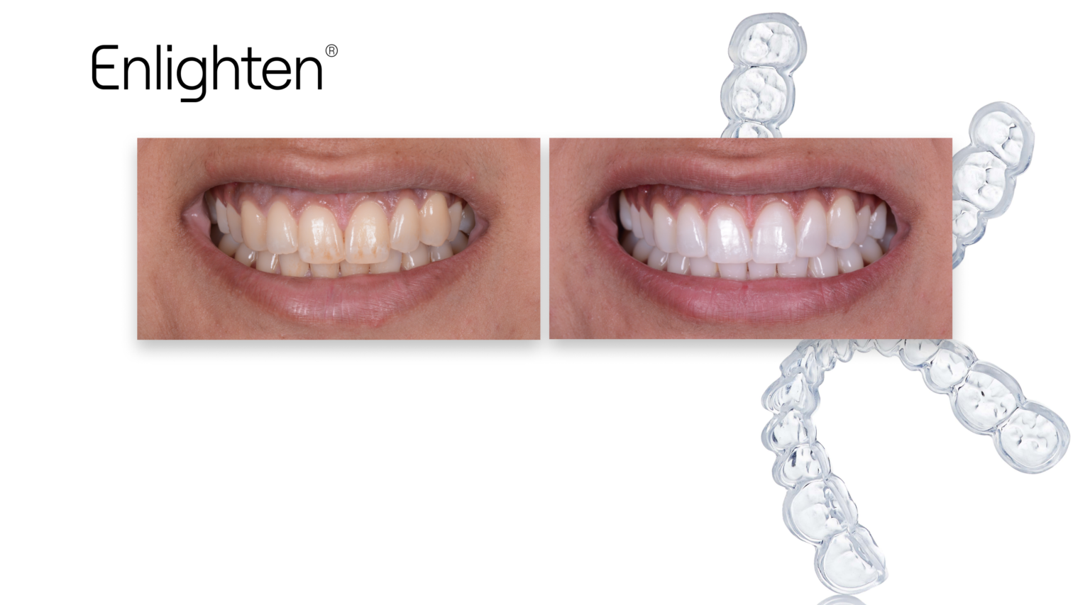 How To Treat Difficult Whitening Cases – Enlighten Smiles Blog
