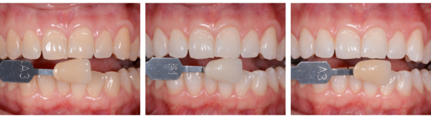 How To Treat Difficult Whitening Cases – Enlighten Smiles Blog