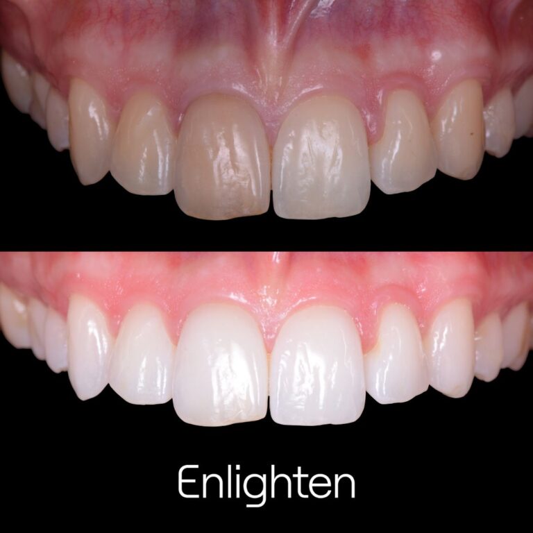 Enlighten's newest teeth whitening system, Evo4!
