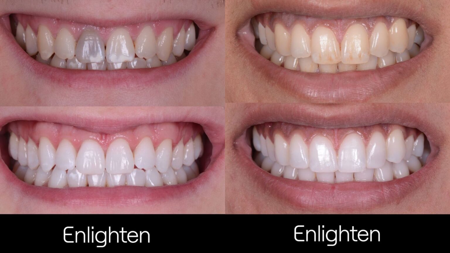 Enlighten’s newest whitening system, Evo4! – Enlighten Smiles Blog